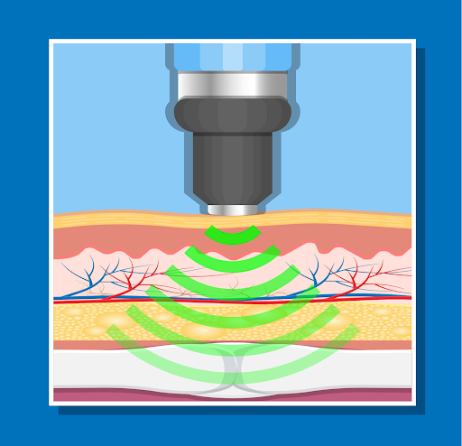 What is Acoustic Compression Therapy - Burkhart Chiropractic, PLC ...